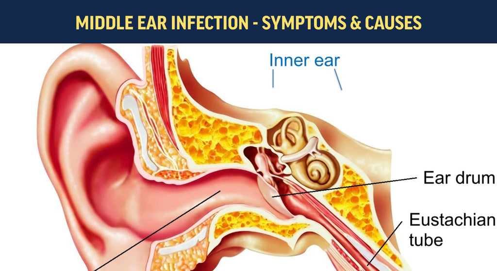 EAR INFECTION (MIDDLE EAR) – SYMPTOMS AND CAUSES – IIMMER Tech.